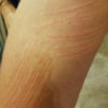 Living w/ Dermatographia-Skin Condition - Life of Alley